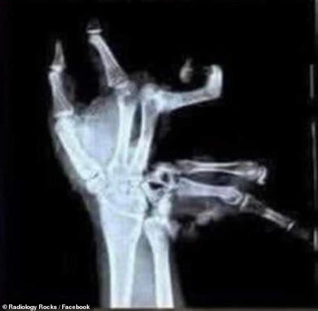 Disturbing X-rays reveal the horrors of lighting off fireworks on the ...