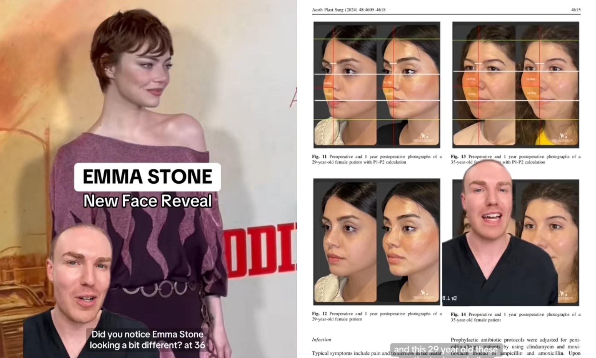 Why does Emma Stone look so different? As fans go wild for Oscar-winner ...