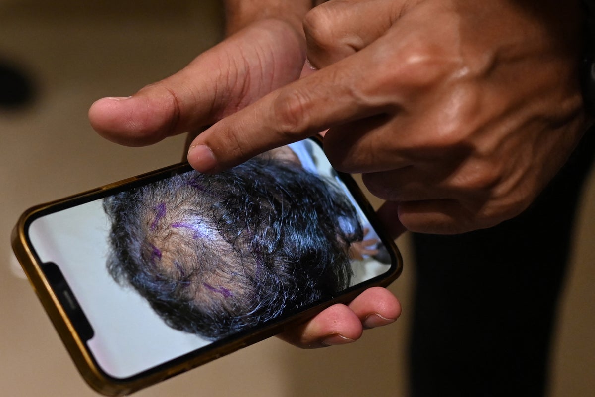 Hair clinic ordered to pay over £5,000 to man who claims not ‘even 1% ...