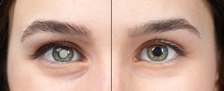How to spot the early signs of a cataract