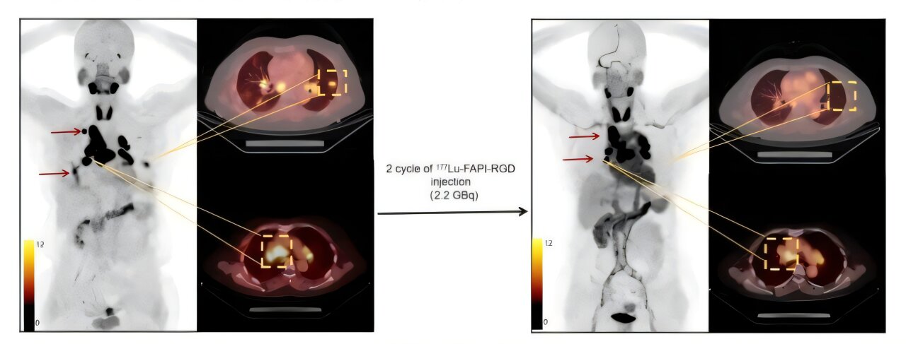 Dual-targeting radiopharmaceutical therapy safe and effective across ...