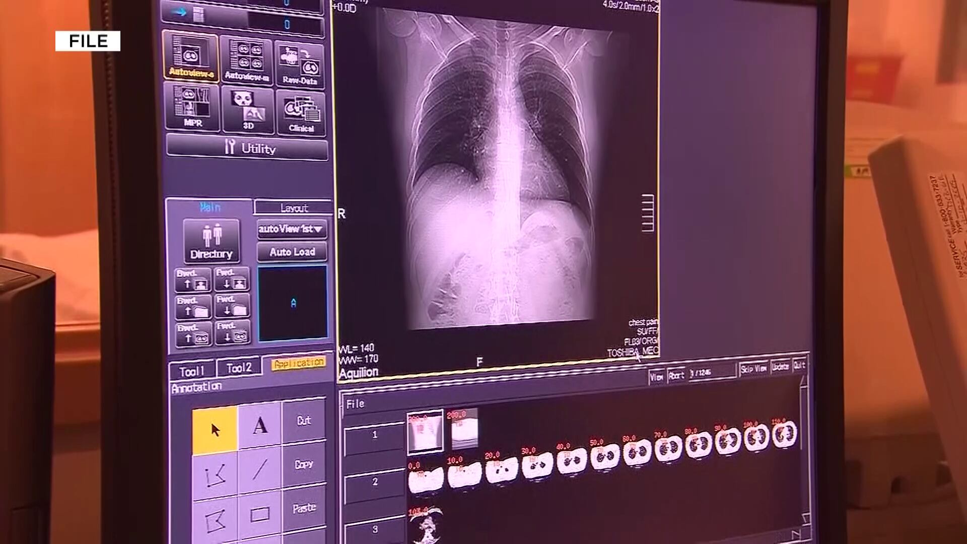 New lung transplant program at Mayo Clinic gives patients a fighting chance