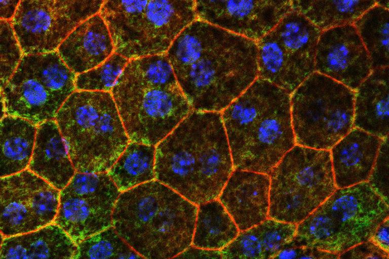 Fixing problems in cholesterol metabolism could stave off a leading ...