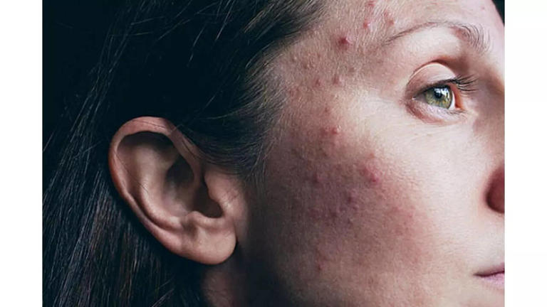 Stress taking a toll on your skin? Causes, conditions, and treatment advice