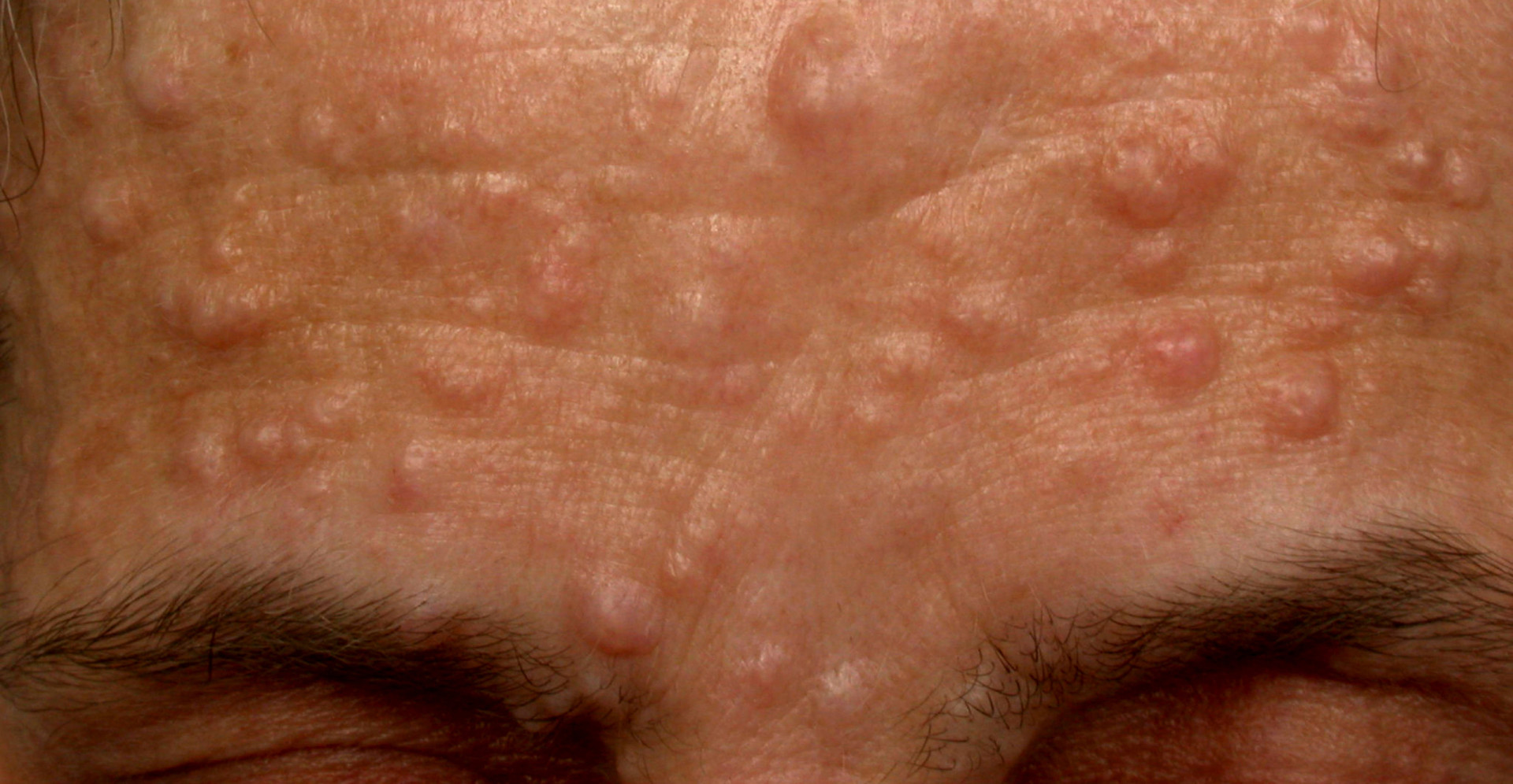 Neurofibromatosis: when tumors develop on nerves