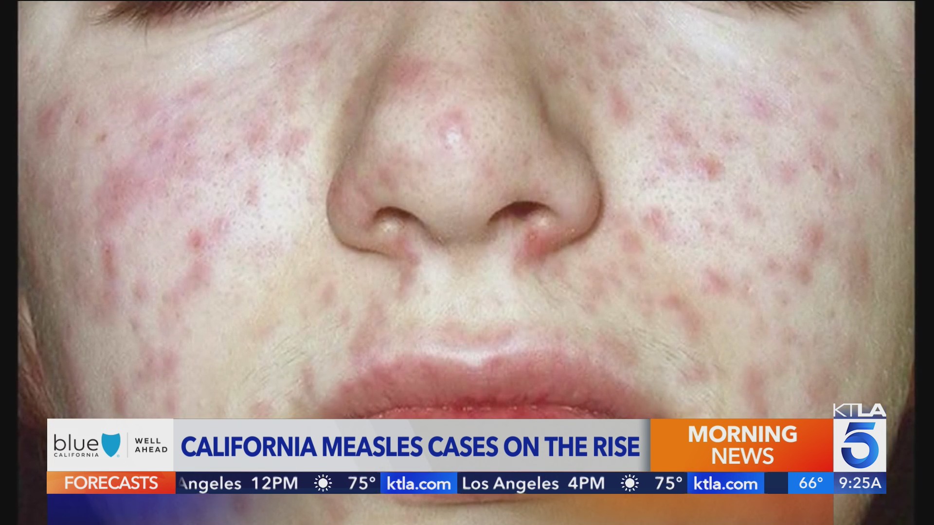 California measles cases this year already past 2024 total