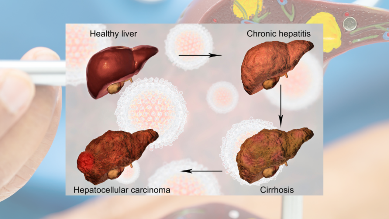 Here's Why Liver Cirrhosis Is Rising, Even Among Non-Drinkers