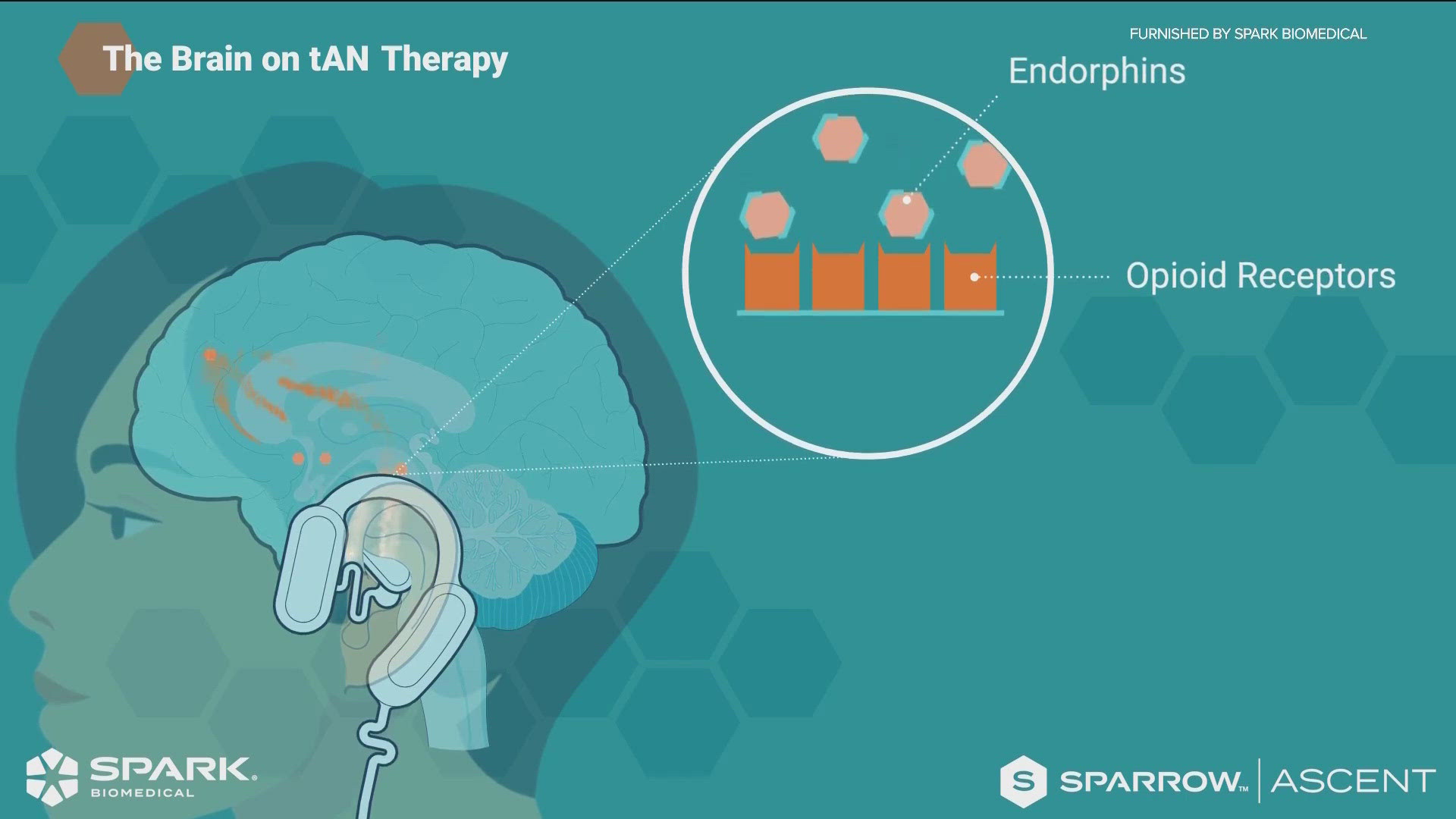 New study shows reduced anxiety and depression with Spark device