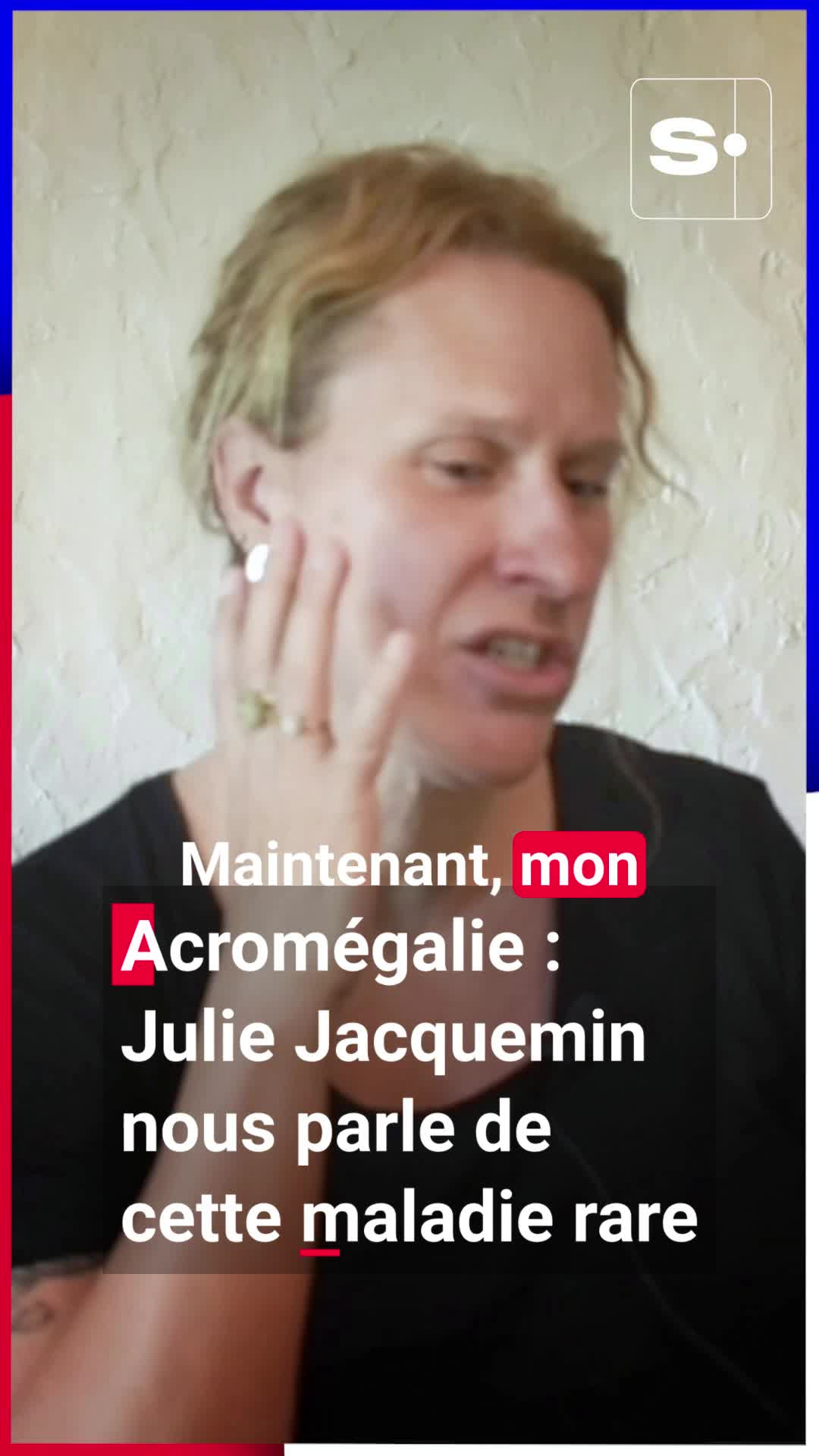 Julie Jacquemin, atteinte d'acromégalie, nous parle de cette maladie rare