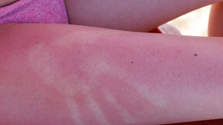The 'most effective' protection to avoid sunburn (and it isn't suncream)
