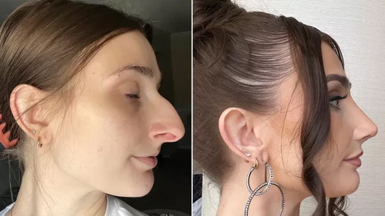 After a Decade of Saving for a Nose Job, Her Confidence Shines Post-Surgery
