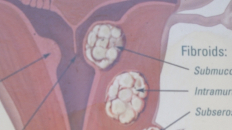 Charlotte woman finds healing with non-invasive fibroid treatment