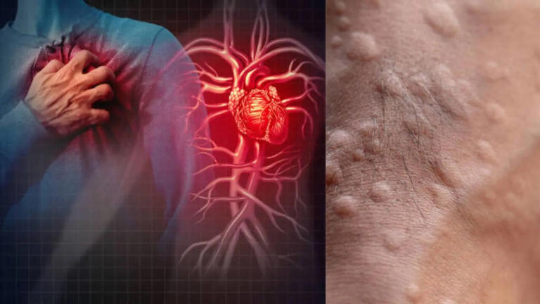 Why is the Golden Hour Critical in a Heart Attack? Here's How the First ...