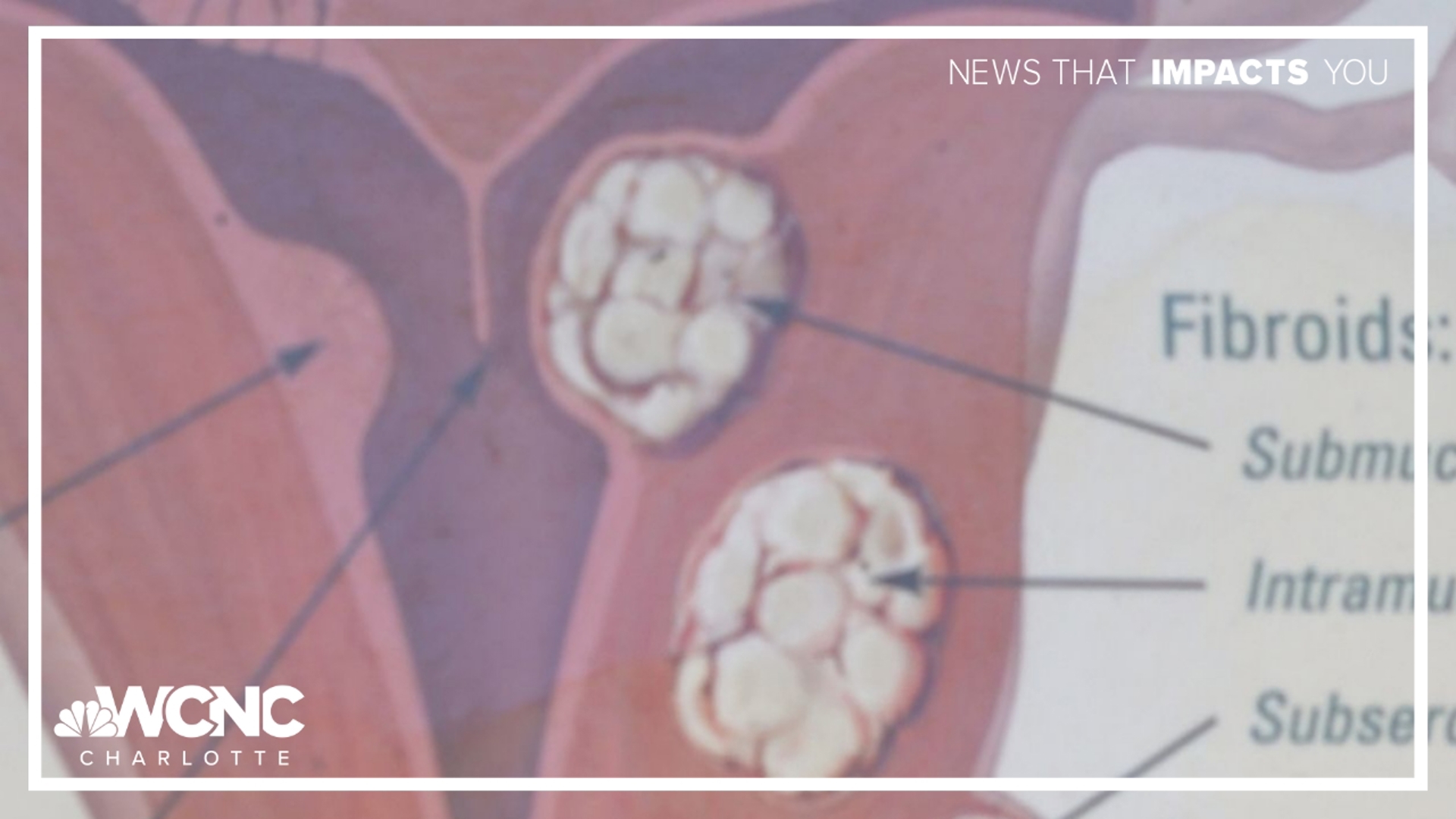 Charlotte woman finds healing with non-invasive fibroid treatment