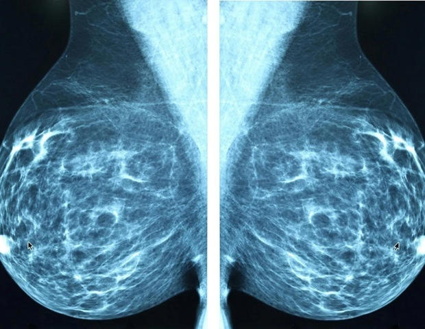 Researchers discover how aggressive breast cancer controls protein ...