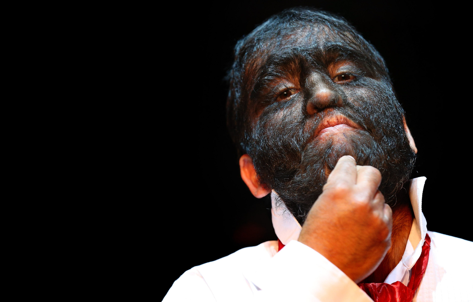 Medical conditions named after mythical creatures