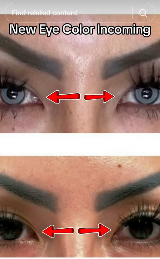 New Cosmetic Surgery Trend Permanently Changes Your Eye Color