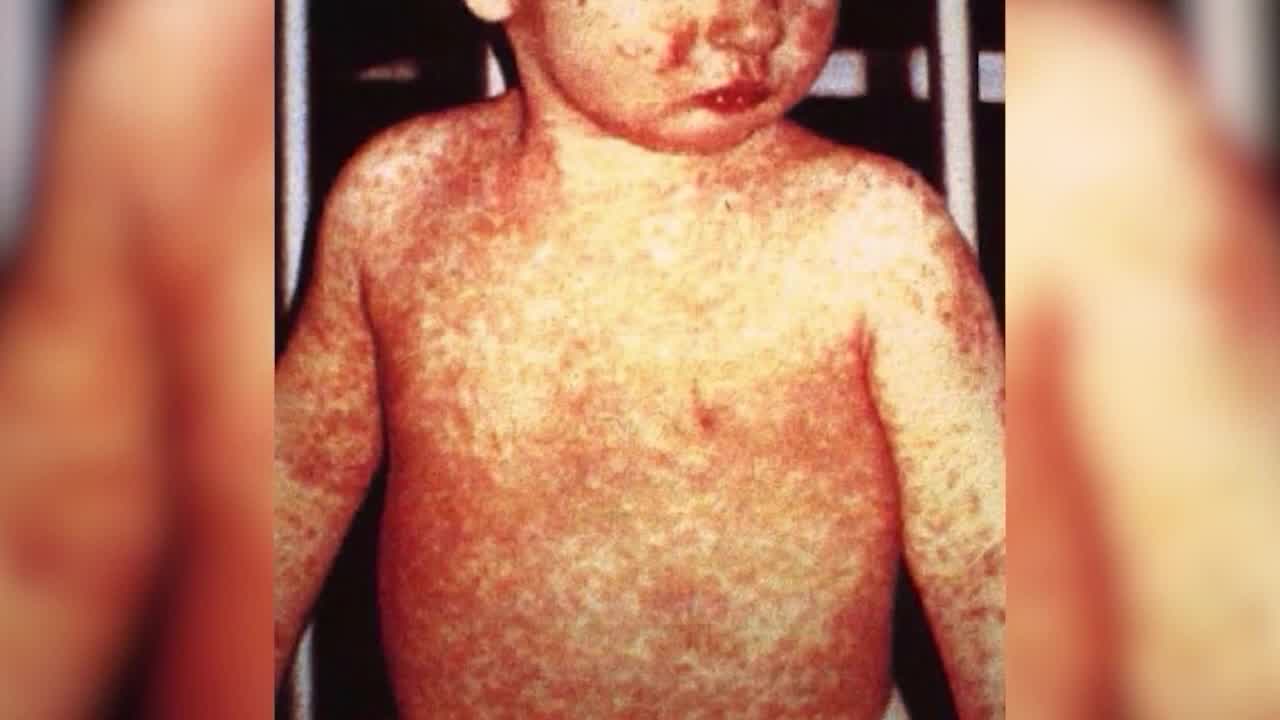 Cleveland Clinic implements new precautions amid measles spike