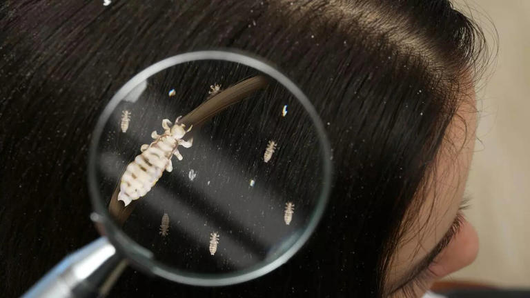 Tired of an itchy scalp? It could be hair lice; know how to treat and ...