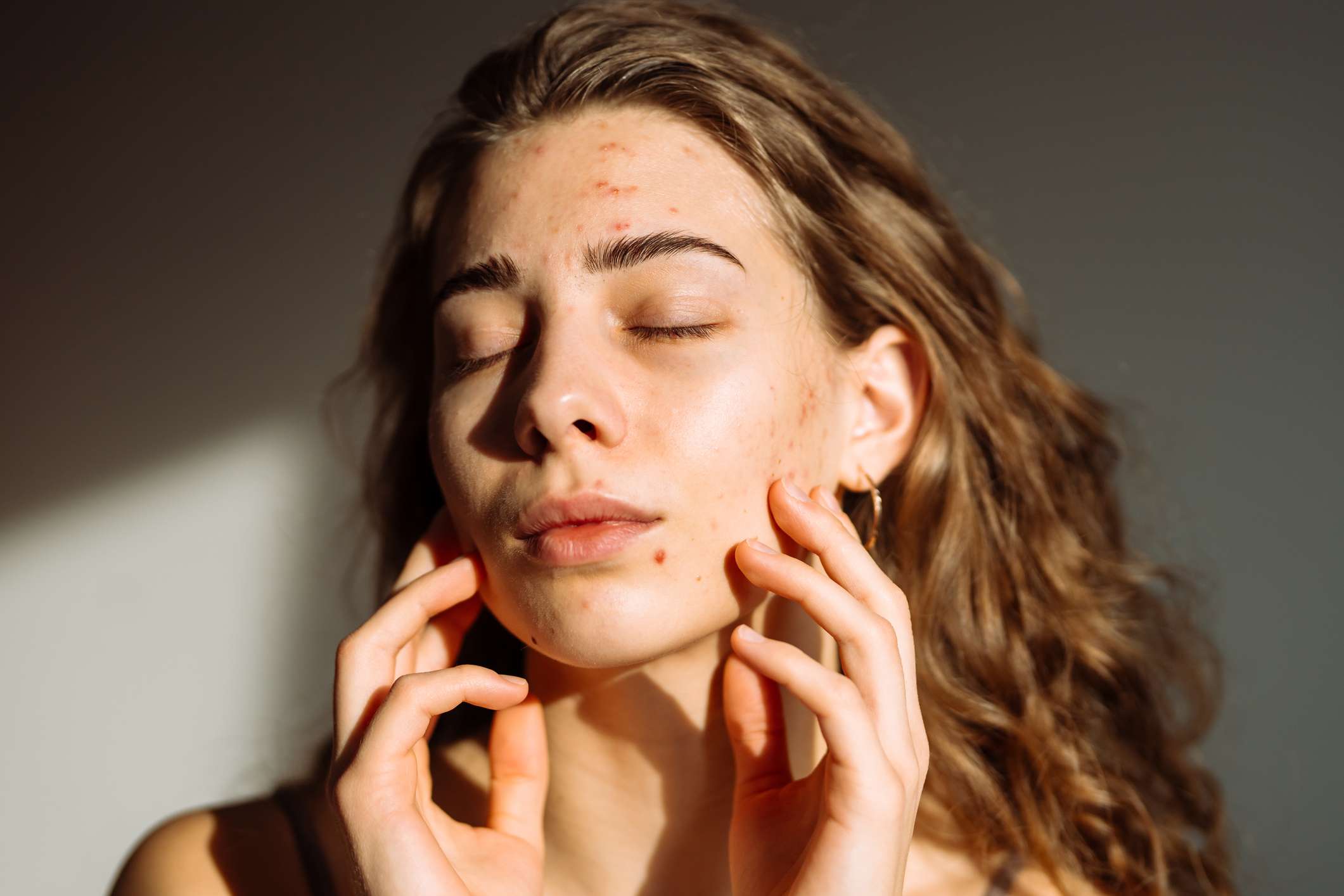 Does Sun Exposure Really Help Acne?