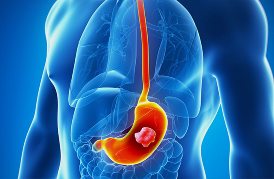 Stomach cancer can be life-threatening; if you want to live long, don't ...
