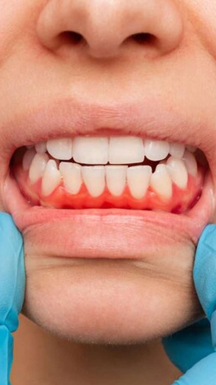 Which Vitamin Deficiency Causes Gum Bleeding?
