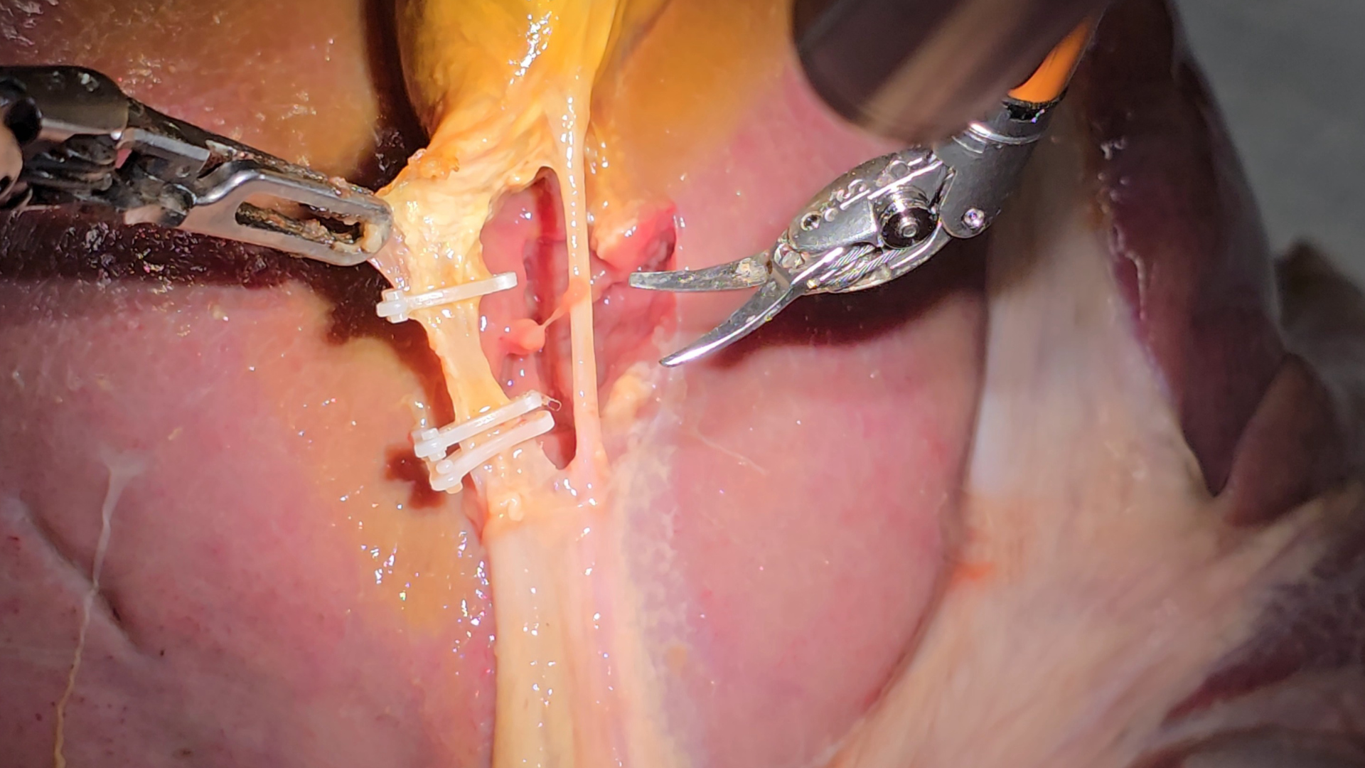 Surgical Robot Performs First Ever Autonomous Gall Bladder Surgery