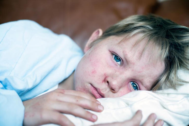 Parents issued urgent measles warning after child dies from 'eliminated ...