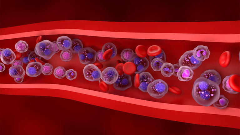 Identifying High-Risk Multiple Myeloma