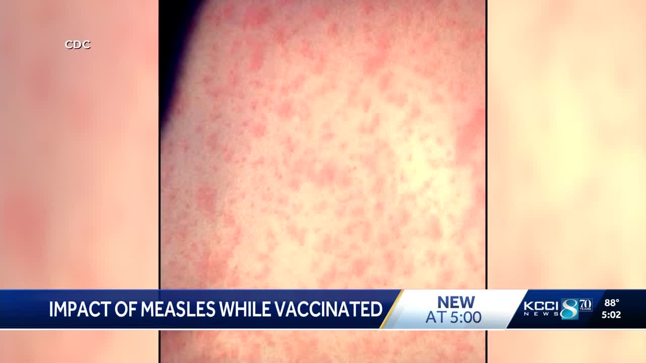 Experts say although possible to get measles despite being vaccinated ...