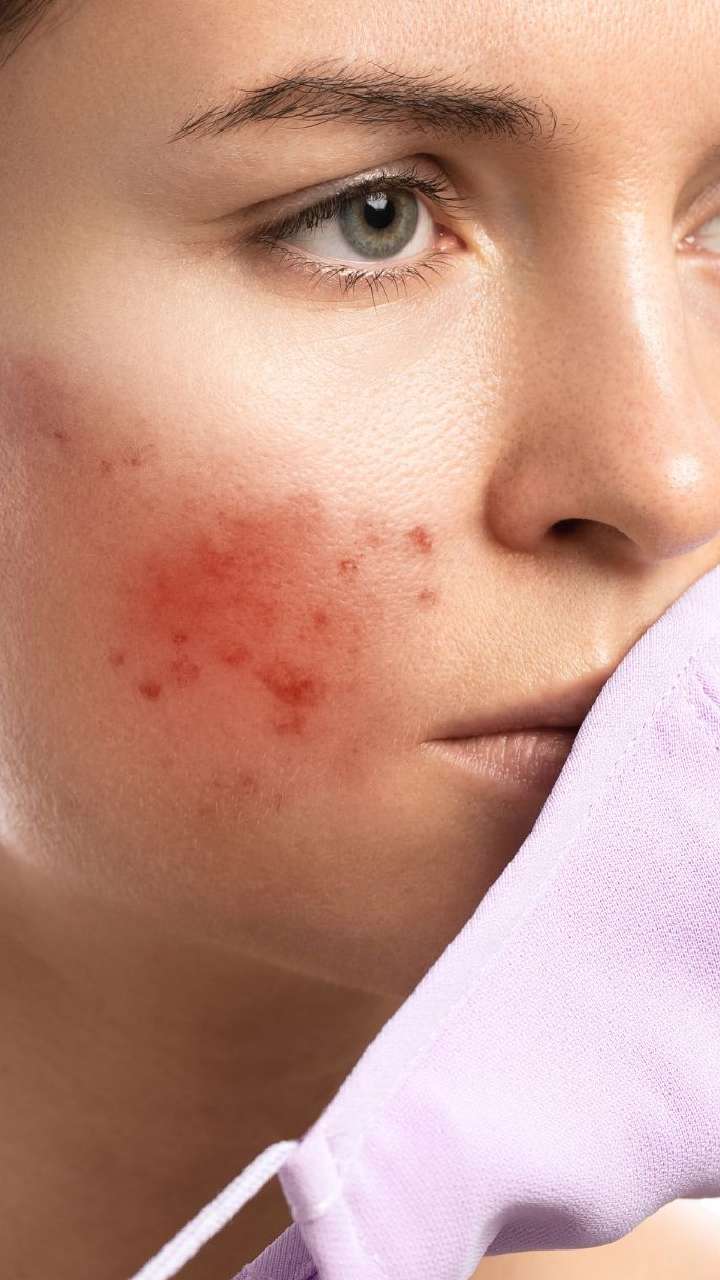 5 Omega 3 Deficiency Symptoms That Occur On Face