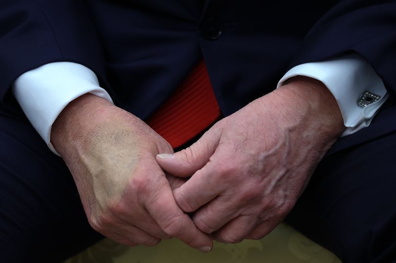 What's going on with Trump's bruised hands? Here's what health ...