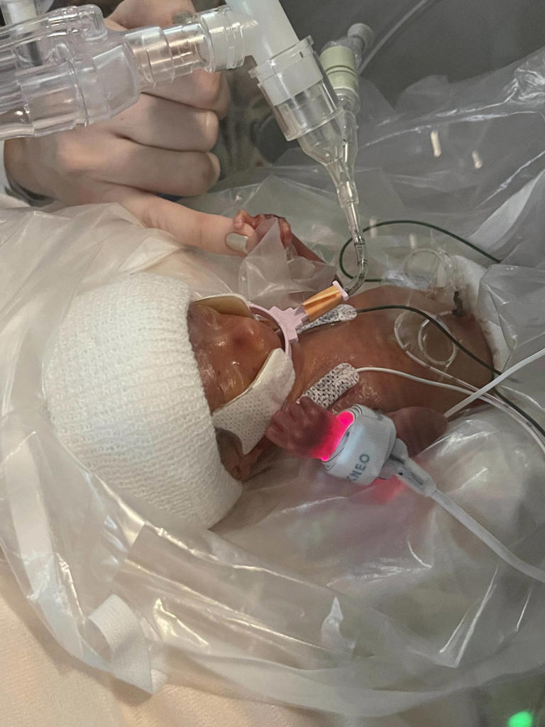 Toddler Born at 22 Weeks Is a 'Miracle' … And He Has the Perfect Name