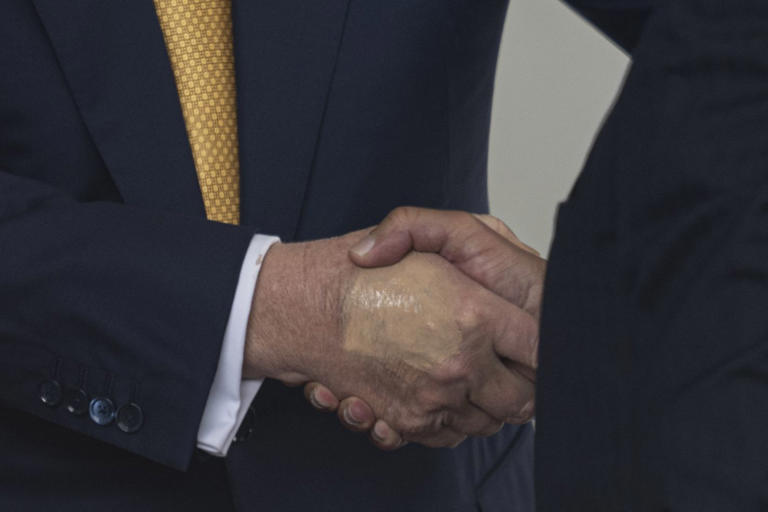 Why Is Trump Putting Makeup on His Very Normal Hand Bruise?