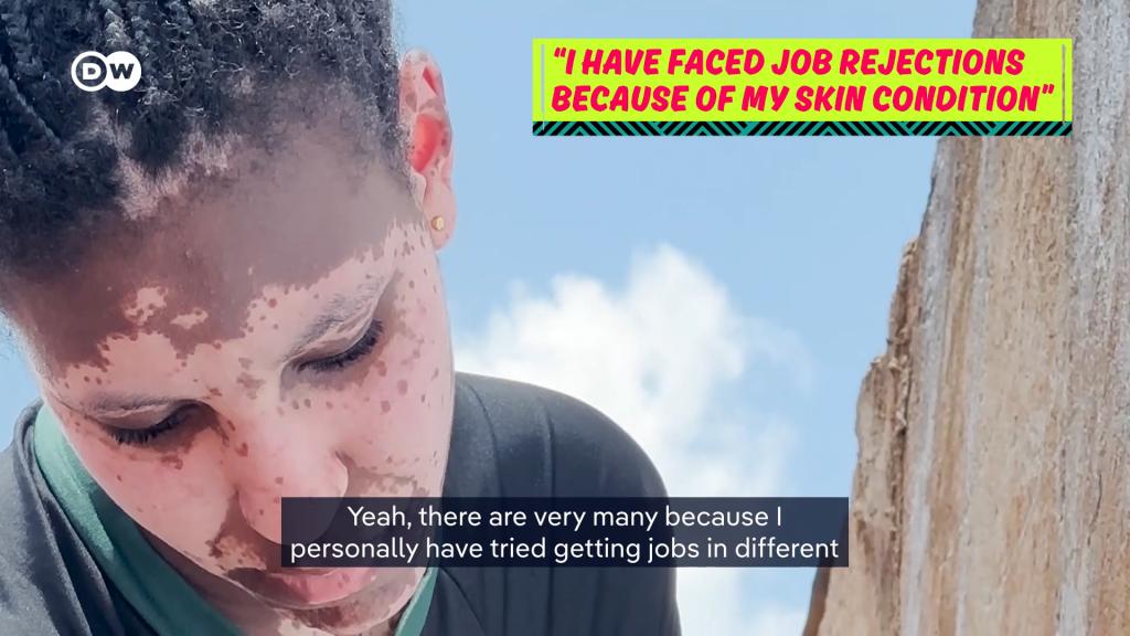 GirlZOffMute — "Not witchcraft. Not a curse. Just a skin condition ...
