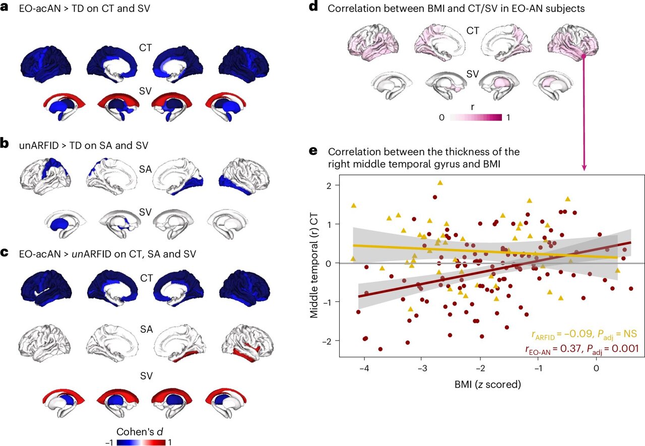 MRI study reveals structural brain changes in children with restrictive ...