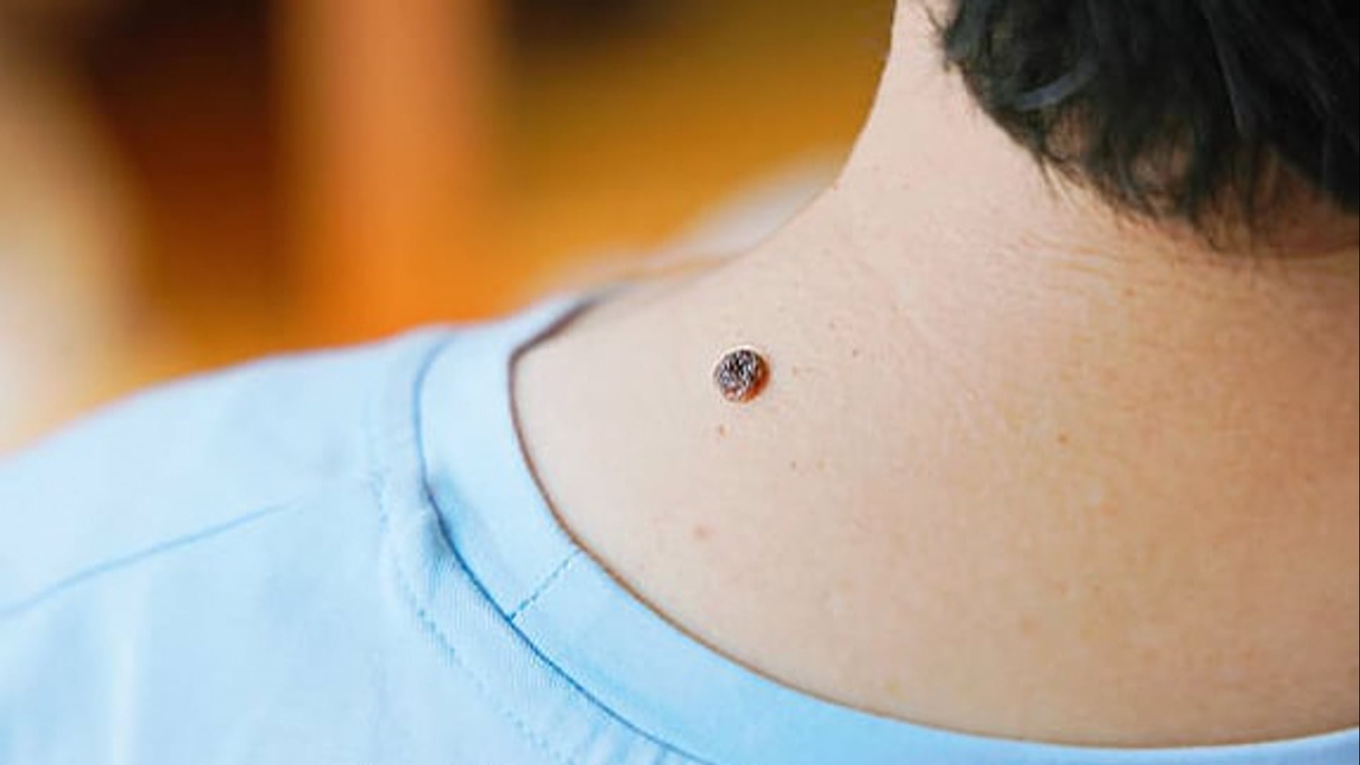 Contrôle des grains de beauté : reconnaître les signes du cancer de la peau