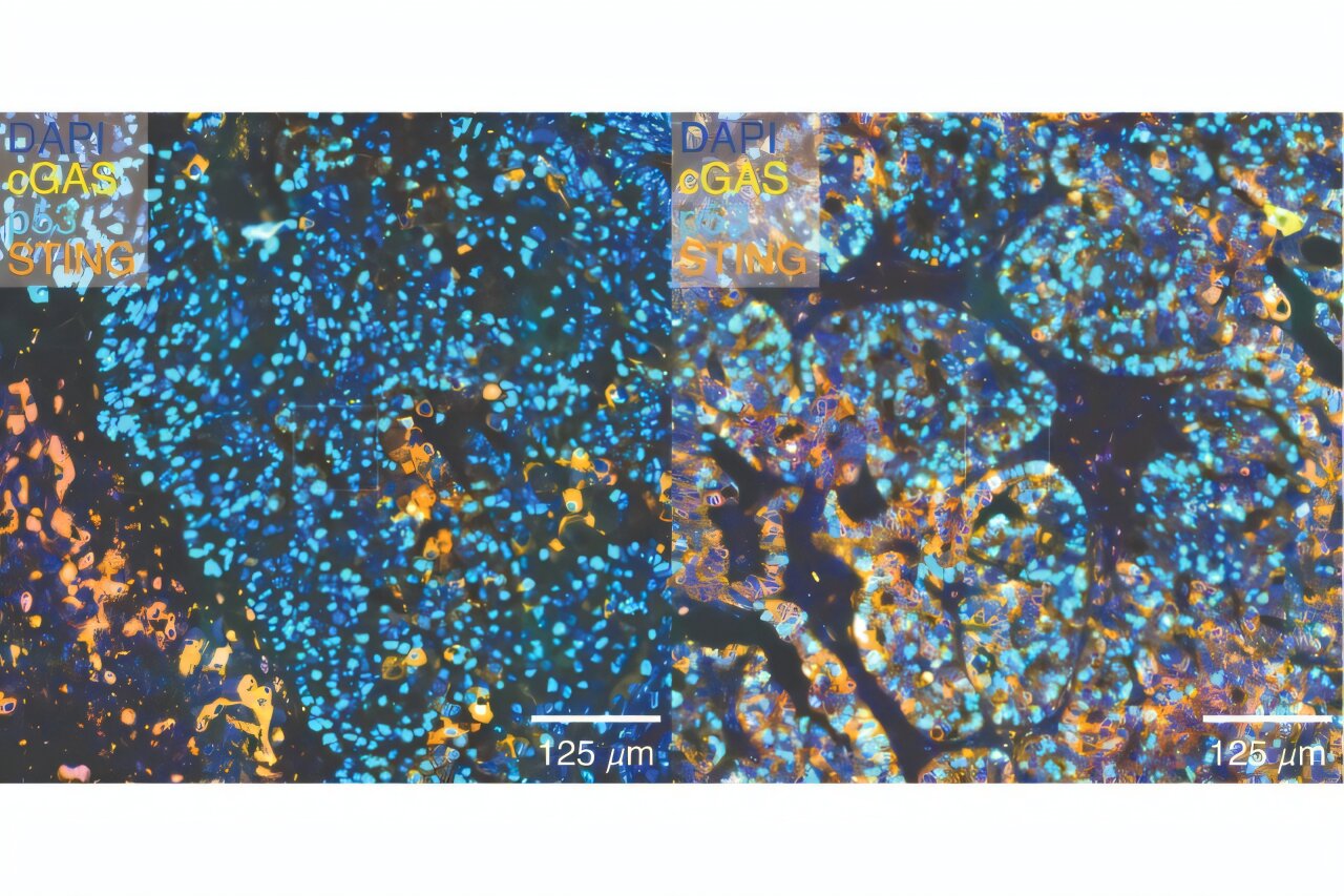New insights into ovarian cancer: Why whole-genome doubling may hold ...