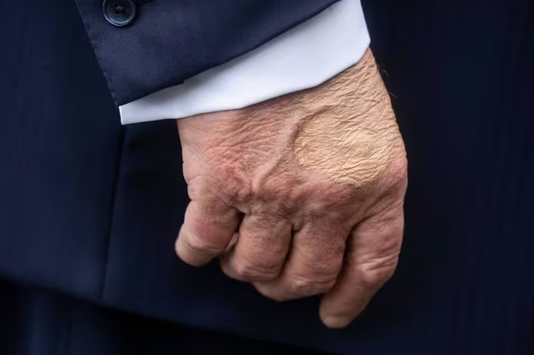 Donald Trump's mystery bruises on hands spark health concerns as he ...