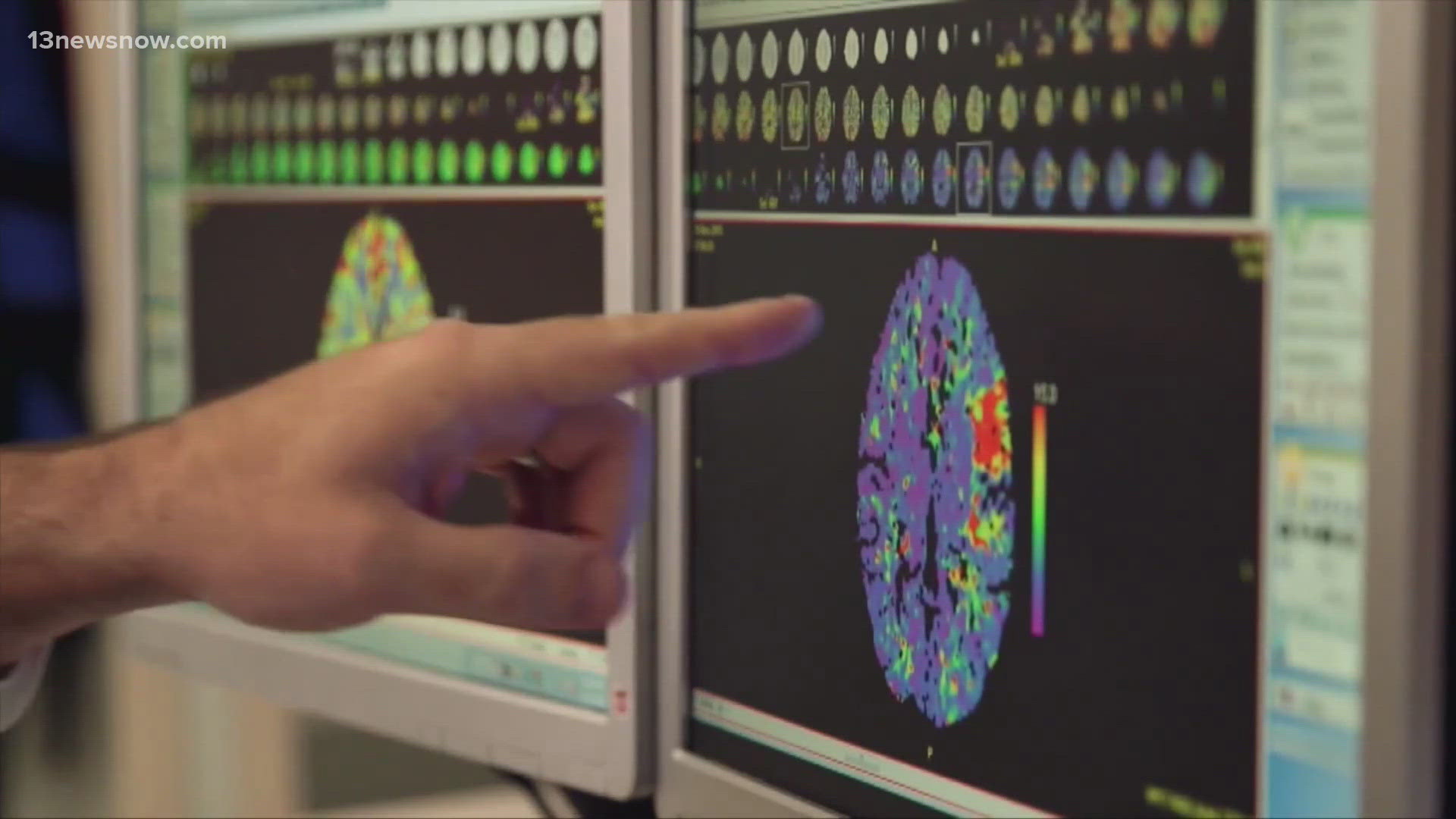 Sentara Health urges Hampton Roads residents to act fast on stroke symptoms