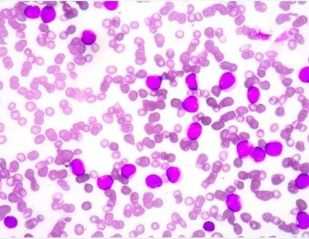 Repurposed Alzheimer’s medication offers low-cost hope for sickle cell ...