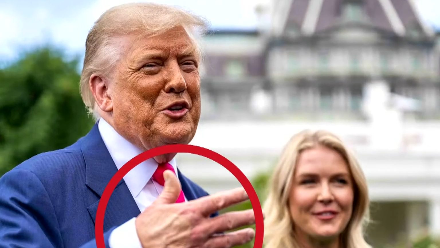 Is Trump's diagnosis benign? Everything to know about chronic venous ...