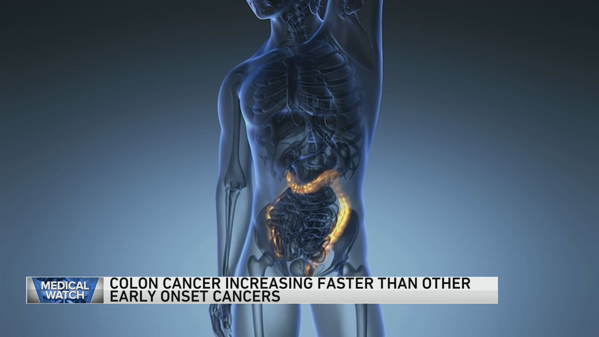 Colon cancer increasing faster than other early onset cancers
