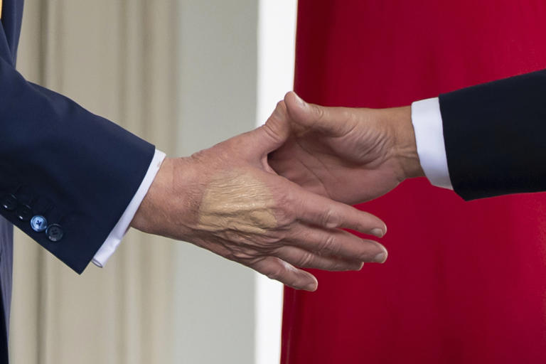 Trump's diagnosis raises questions following leg swelling