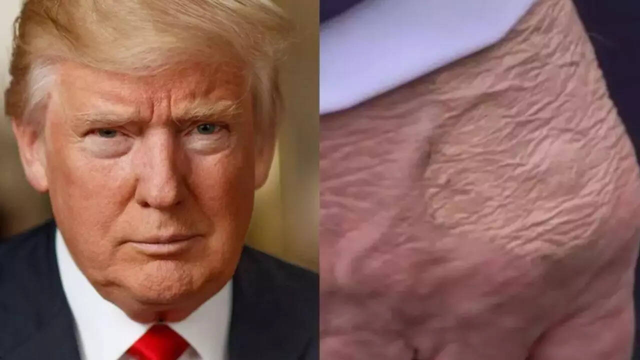 Donald Trump health update: What is U.S. President's condition after ...
