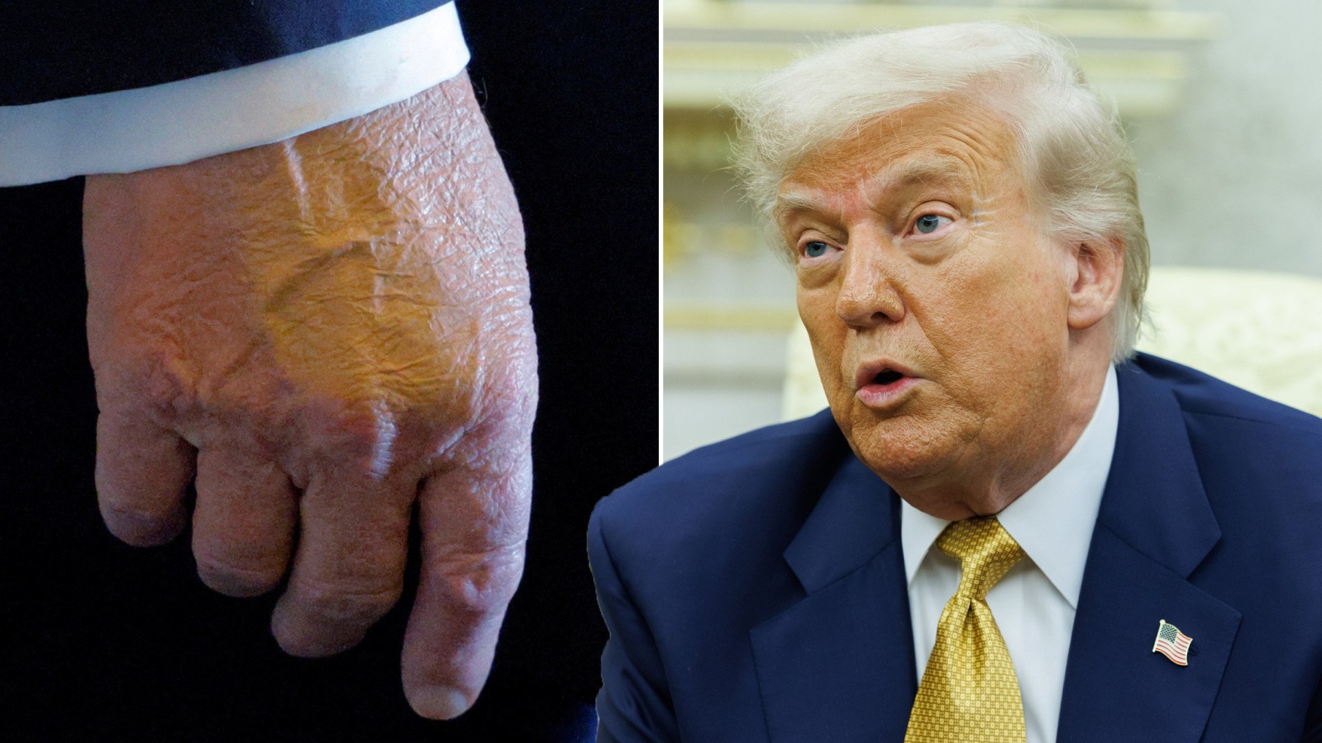 Trump diagnosed with chronic vein issue after swelling