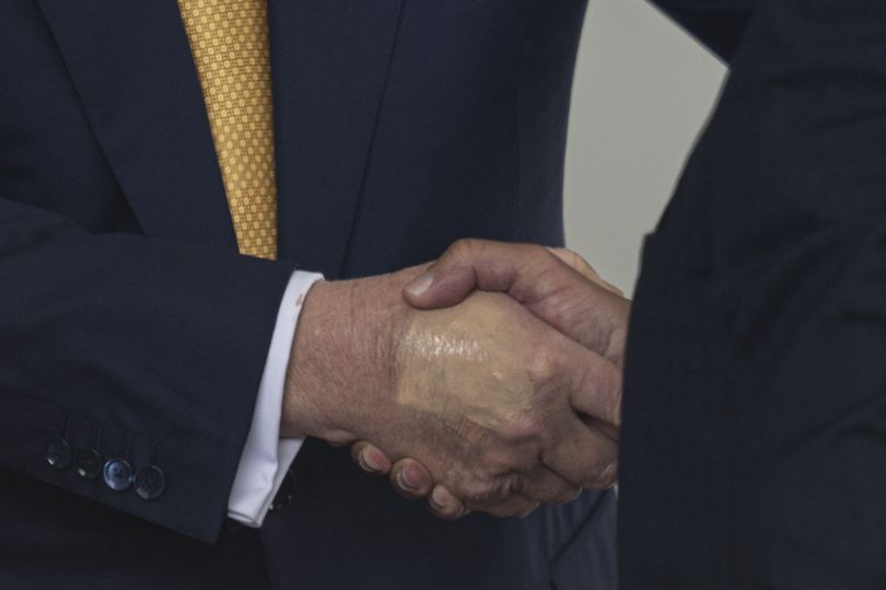 Donald Trump's health condition CVI explained after make-up on hand