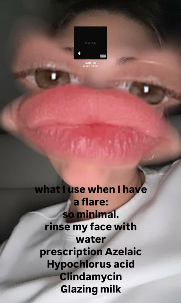 Dr. Morales Raya, dermatólogo, sobre la dermatitis perioral de Hailey ...