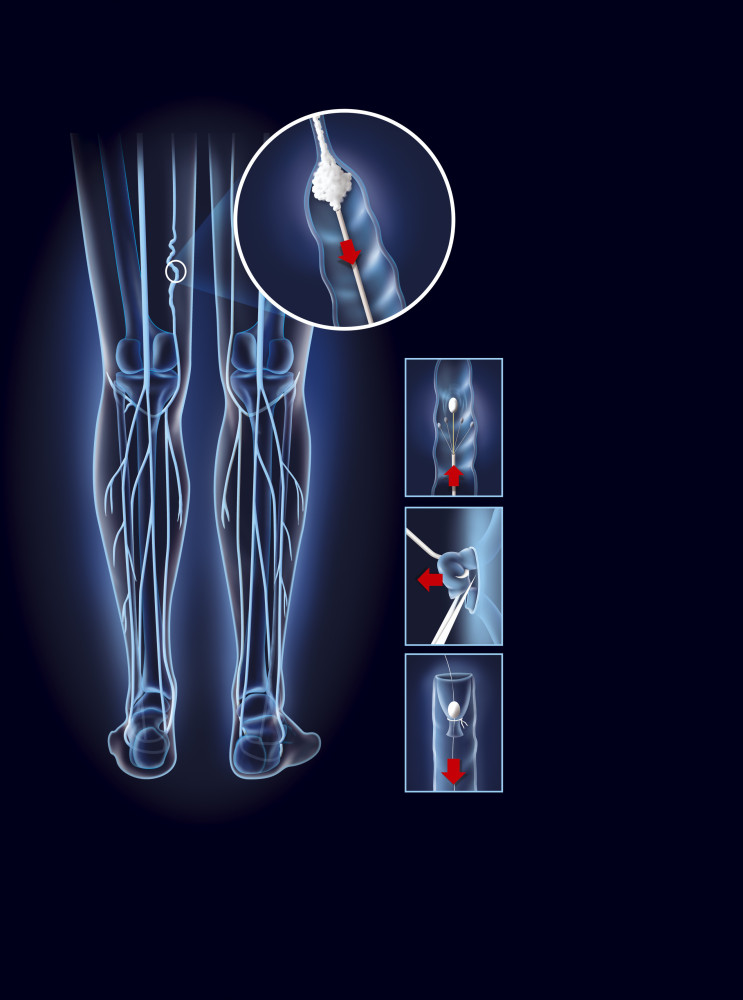 What's chronic venous insufficiency, the disease plaguing the US president?