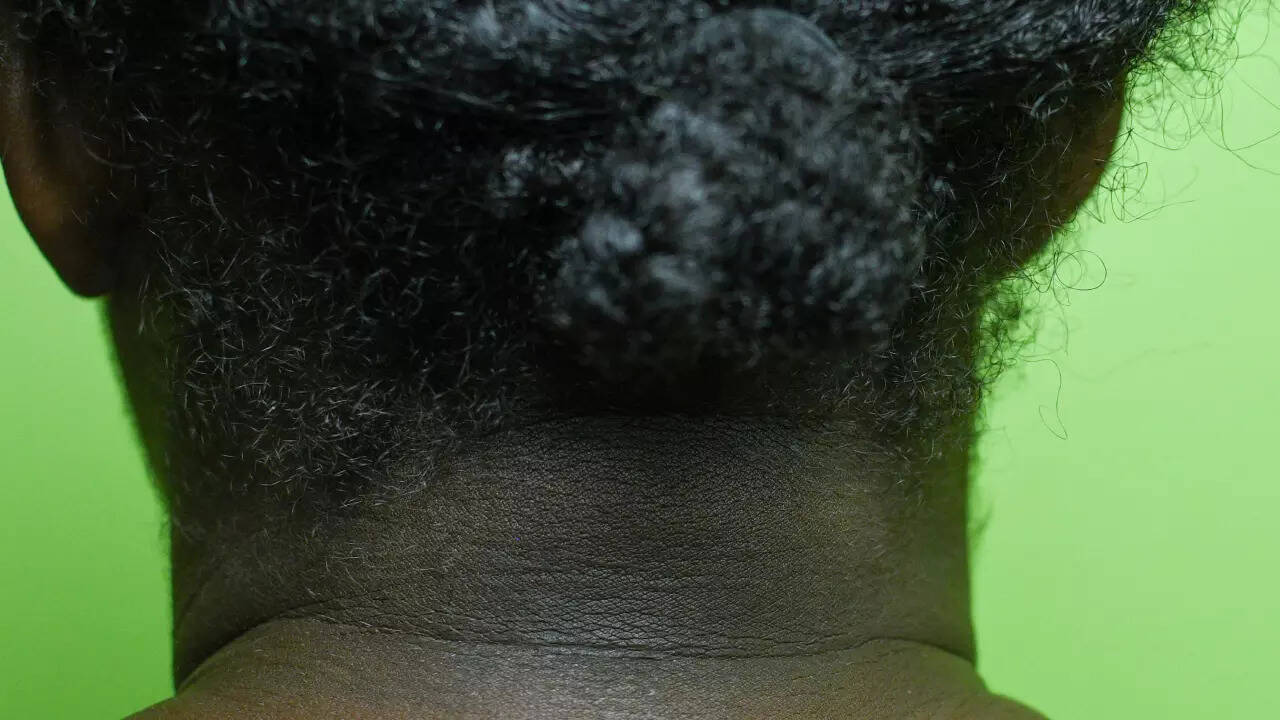 7 often overlooked symptoms of pre-diabetes